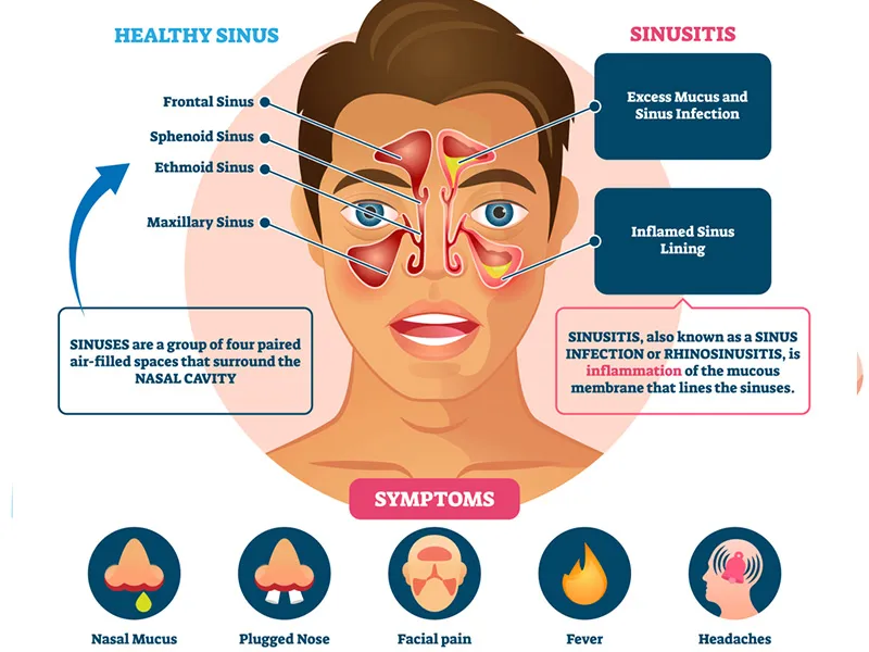 Sinusitis